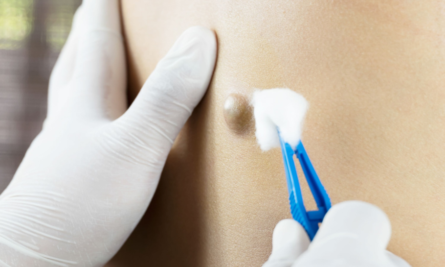 Sebaceous cysts